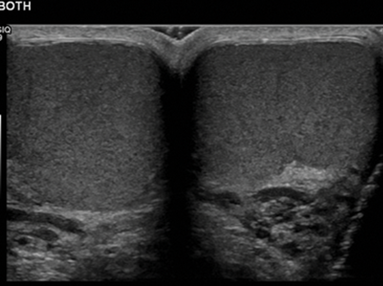 Normal Epididymis Ultrasound Epos™