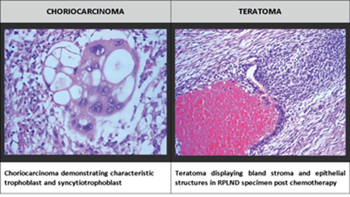 Management of stage 1 non-seminomatous germ cell tumours | Urology News