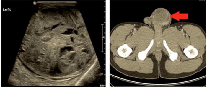 Management of stage 1 non-seminomatous germ cell tumours | Urology News