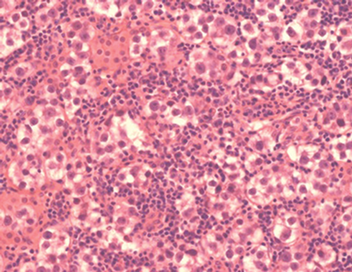 Testicular cancer: management of stage I seminoma | Urology News