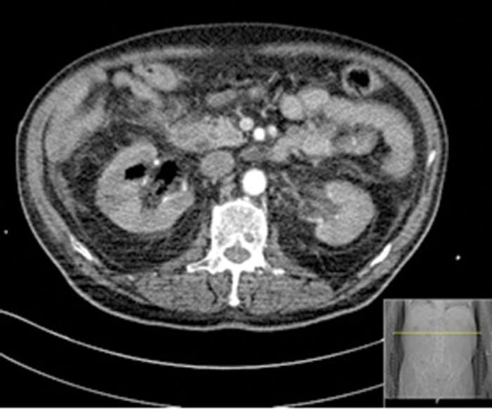 Emphysematous pyelonephritis: a review | Urology News