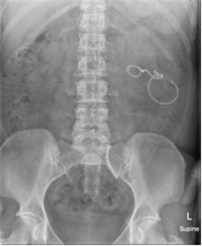 Ureteric strictures | Urology News