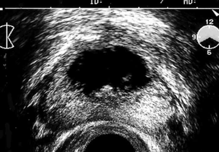 Lasers in benign prostatic hyperplasia | Urology News