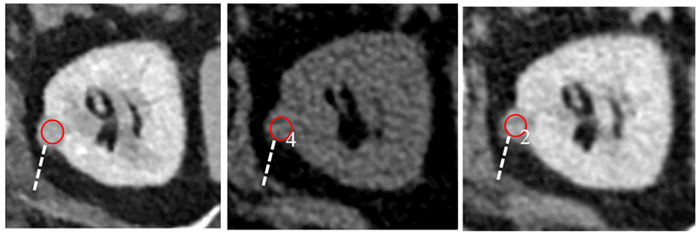 Indeterminate Renal Lesions A Pragmatic Imaging Approach Urology News