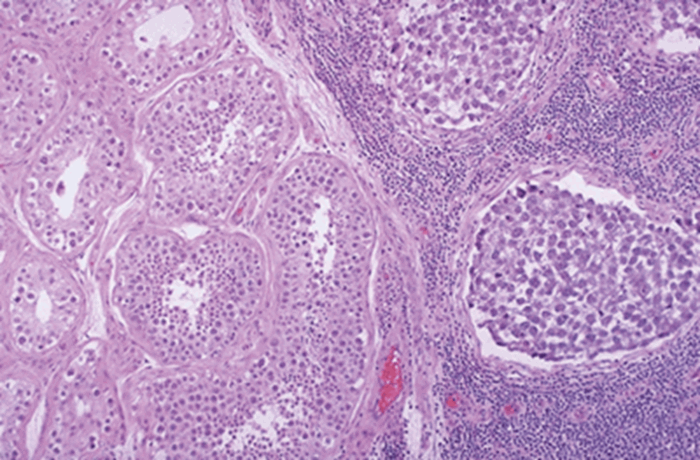 Uropathology: what’s the diagnosis? | Urology News