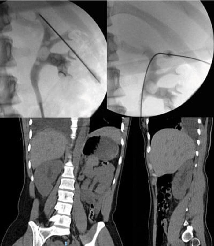 A guide to percutaneous nephrolithotomy | Urology News