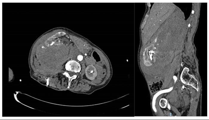 A guide to percutaneous nephrolithotomy | Urology News