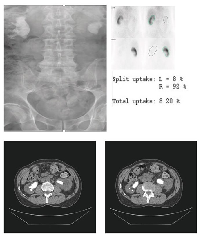 Urinary tract stones | Urology News