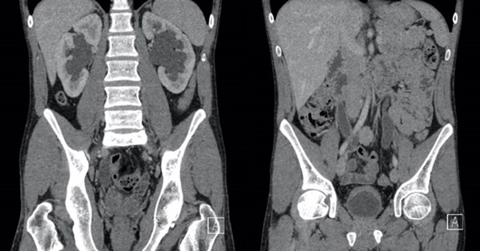 Ketamine uropathy – an update | Urology News