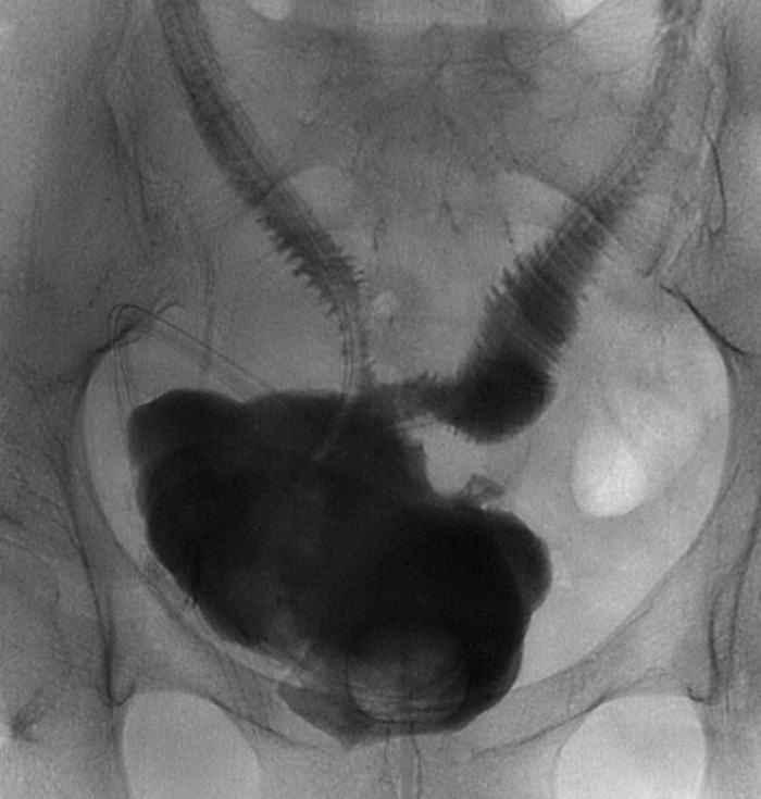 Ketamine uropathy – an update | Urology News