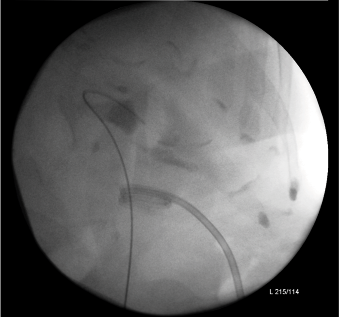 Demanding cases or nightmares in endourology? Nov/Dec 2017 | Urology News