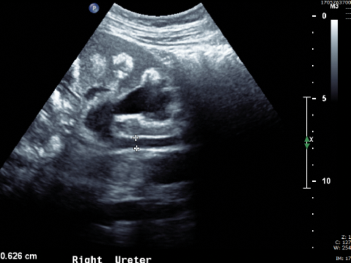 Nephrocalcinosis | Urology News