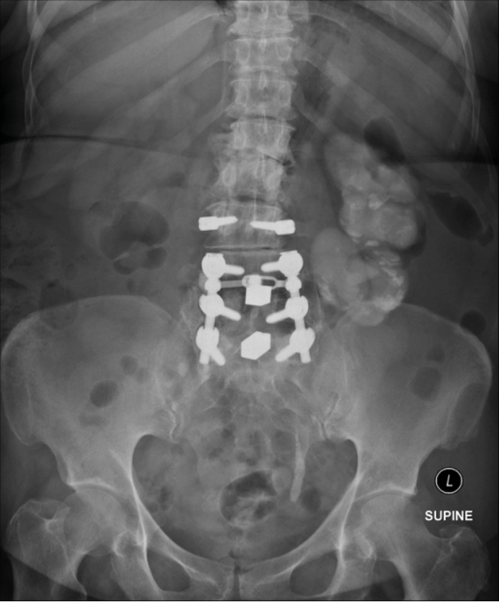 Nephrocalcinosis | Urology News