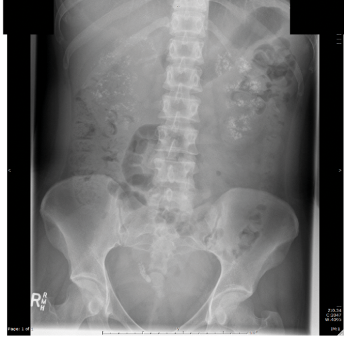 Nephrocalcinosis | Urology News