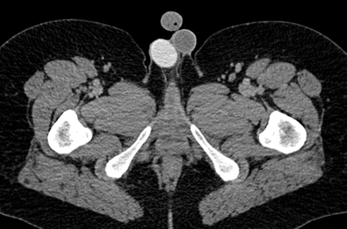 Testicular Tumour Imaging Urology Medicaltalk Net The Best
