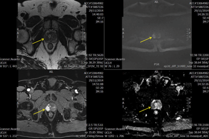 The PROMIS trial – time for multi-parametric MRI before a first ...