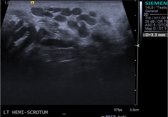 Varicocele Ultrasound Video
