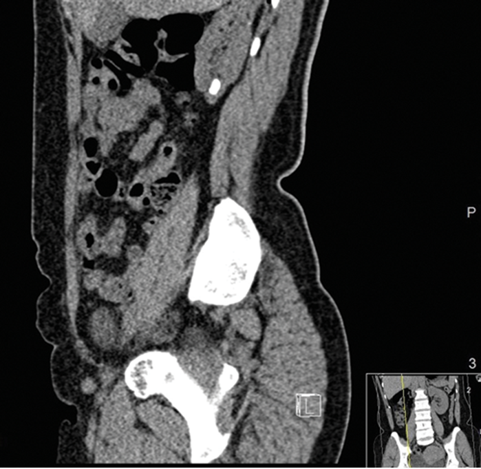 Management of calyceal diverticular stones using ultramini PCNL ...