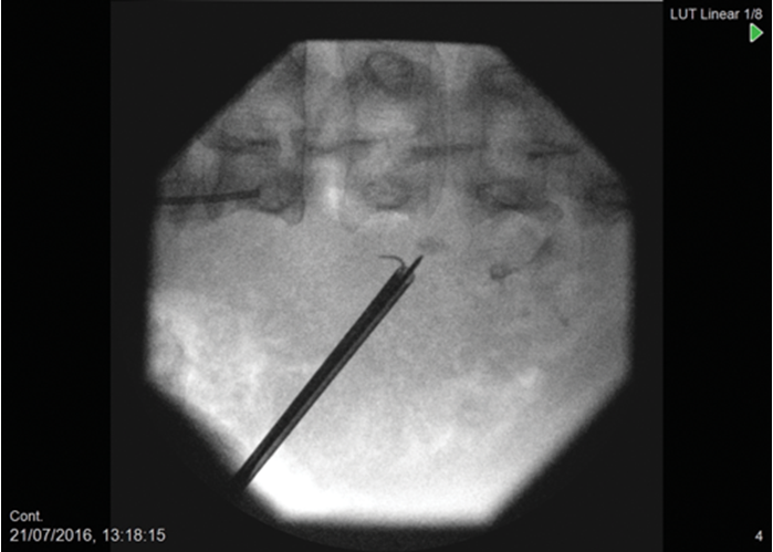 Management of calyceal diverticular stones using ultramini PCNL ...