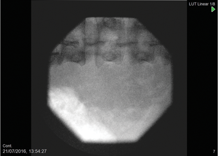 Management of calyceal diverticular stones using ultramini PCNL ...