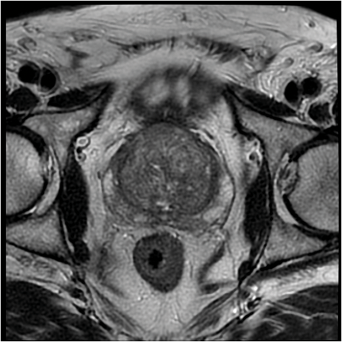 The assessment and medical treatment of LUTS secondary to BPH | Urology ...