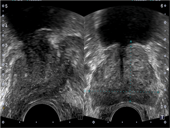 The assessment and medical treatment of LUTS secondary to BPH | Urology ...