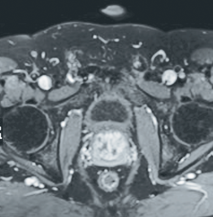 Prostate artery embolisation | Urology News