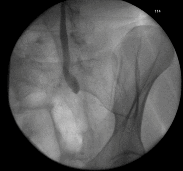 Meeting in the middle: a review of the rendezvous technique to treat ...