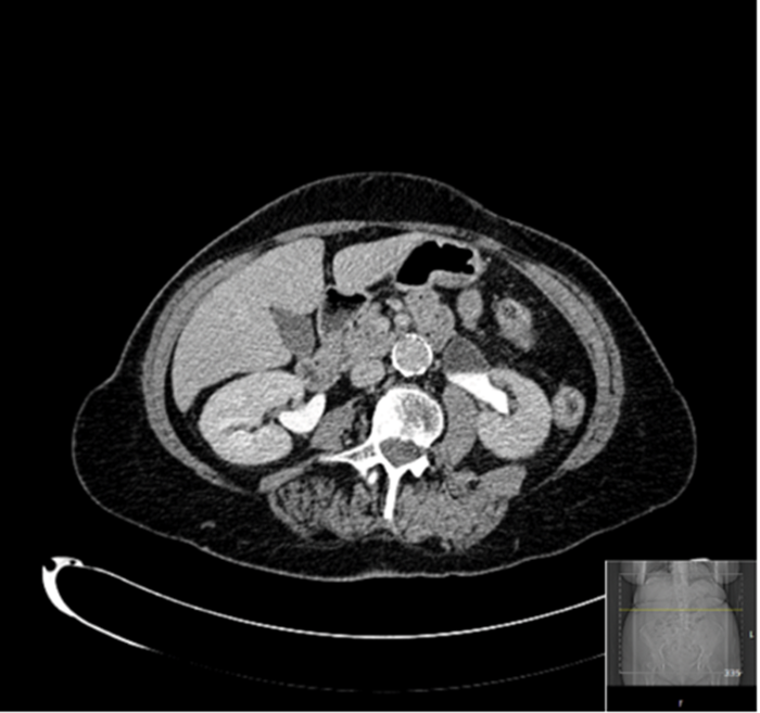 Demanding cases or nightmares in endourology? Sep/Oct 2016 | Urology News