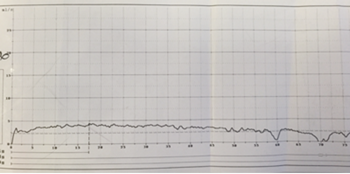Bladder outlet obstruction | Urology News