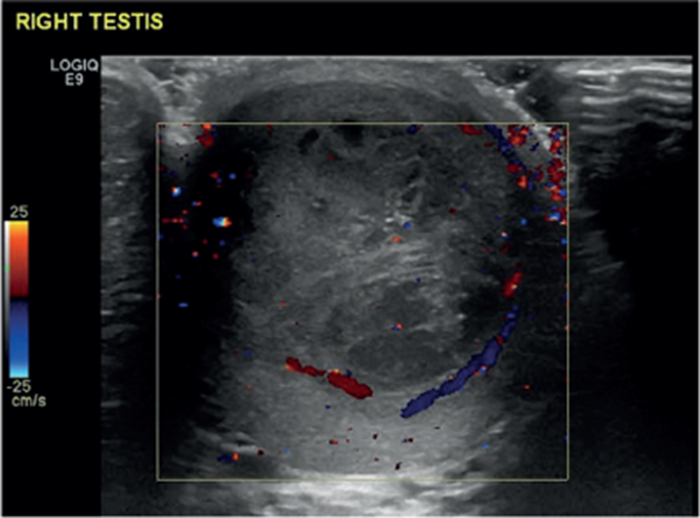 Testicular cancer (Jan 2016) | Urology News