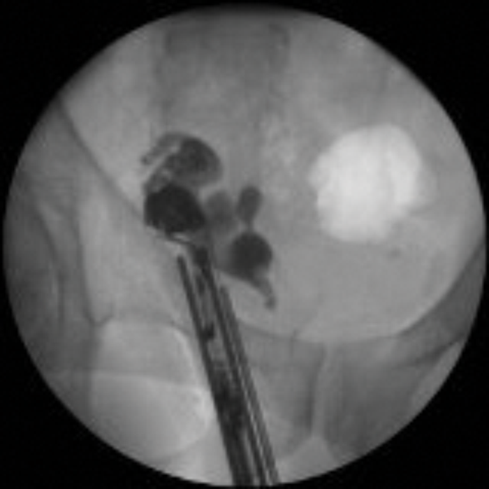 Seminal vesicle calculi | Urology News